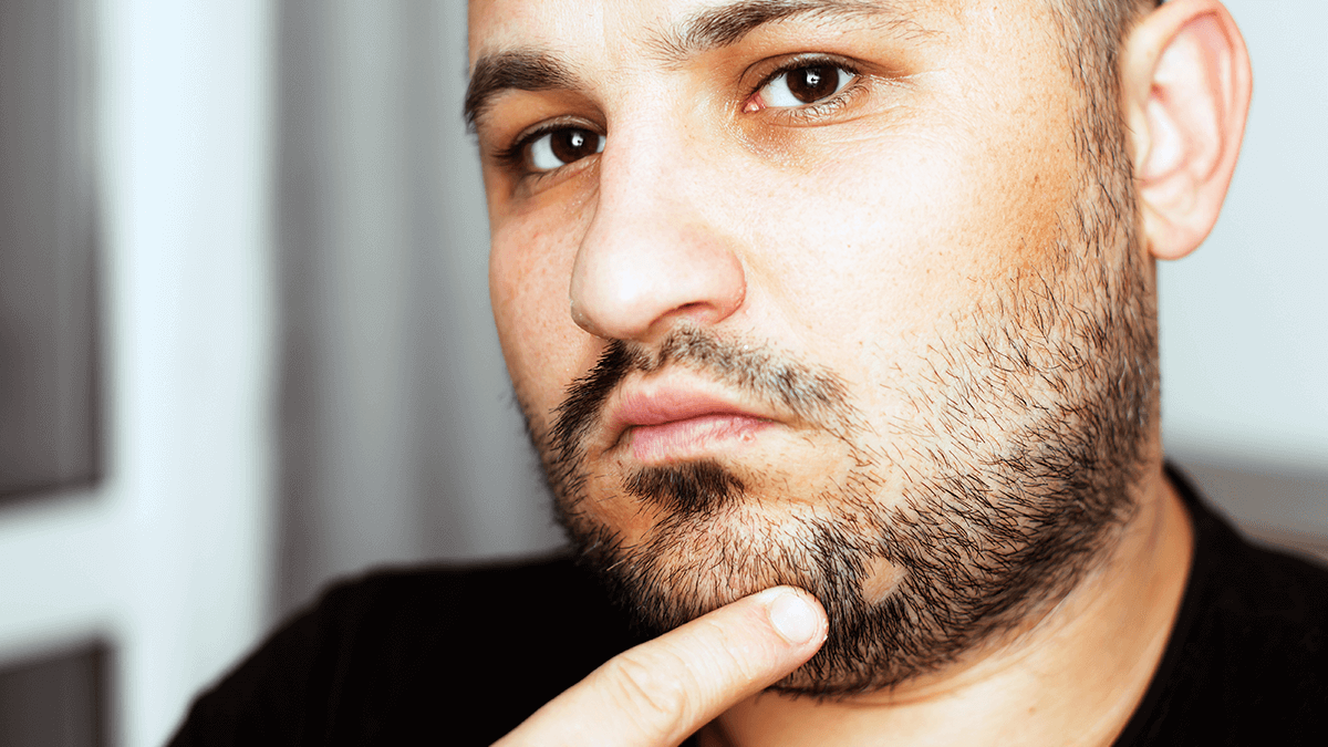 Beard Balding - Causes, symptoms and treatments for men