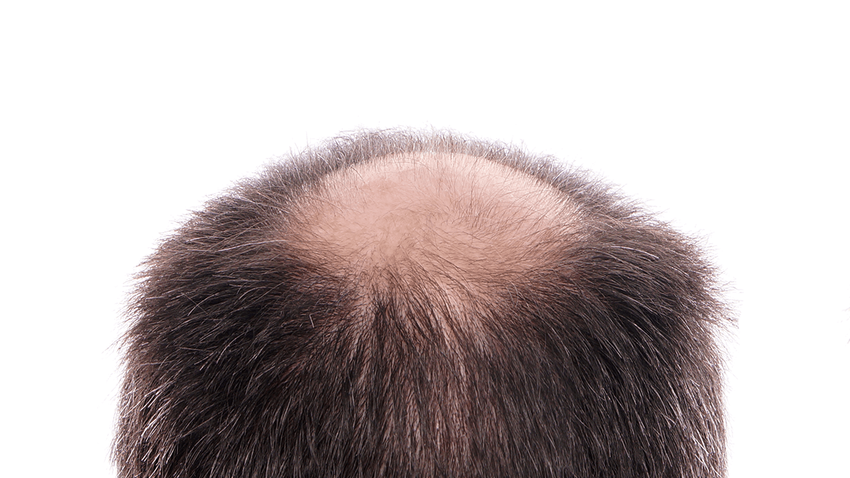 Crown Hair Transplant - All you need to know 2023