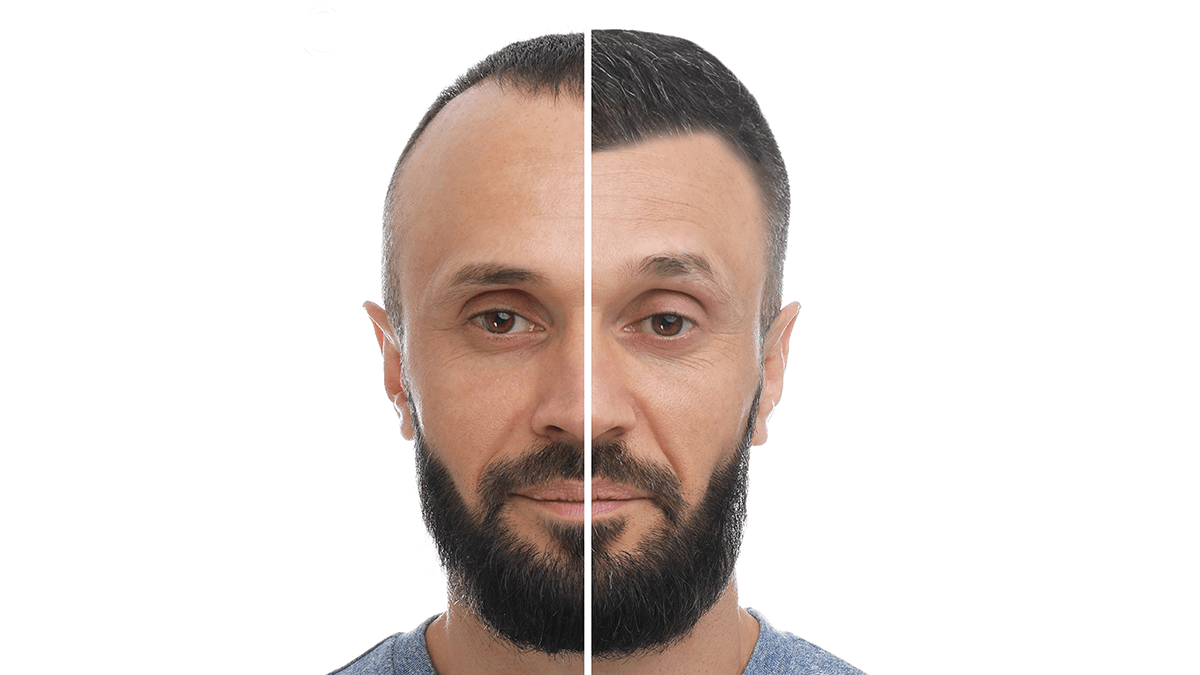 DHI Hair Transplants - A deep explanation of the technique