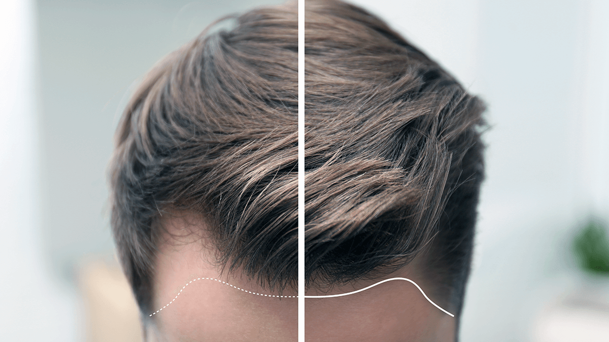 FUE Hair Transplants - A deep explanation of the technique