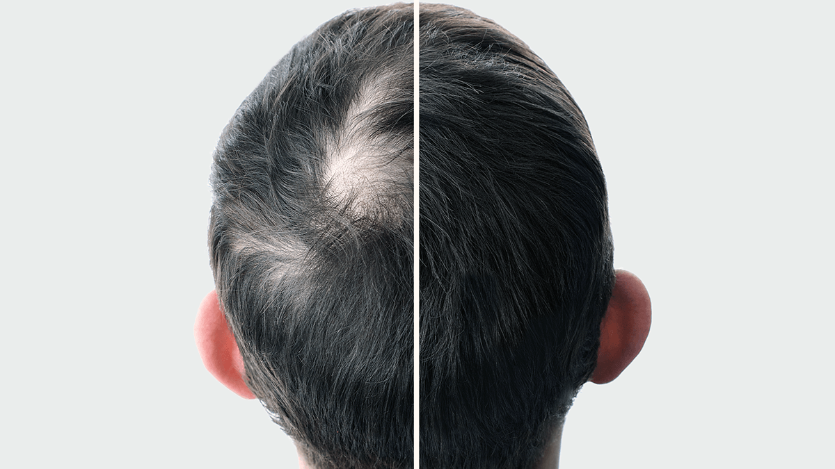FUT Hair Transplant - A deep explanation of the technique