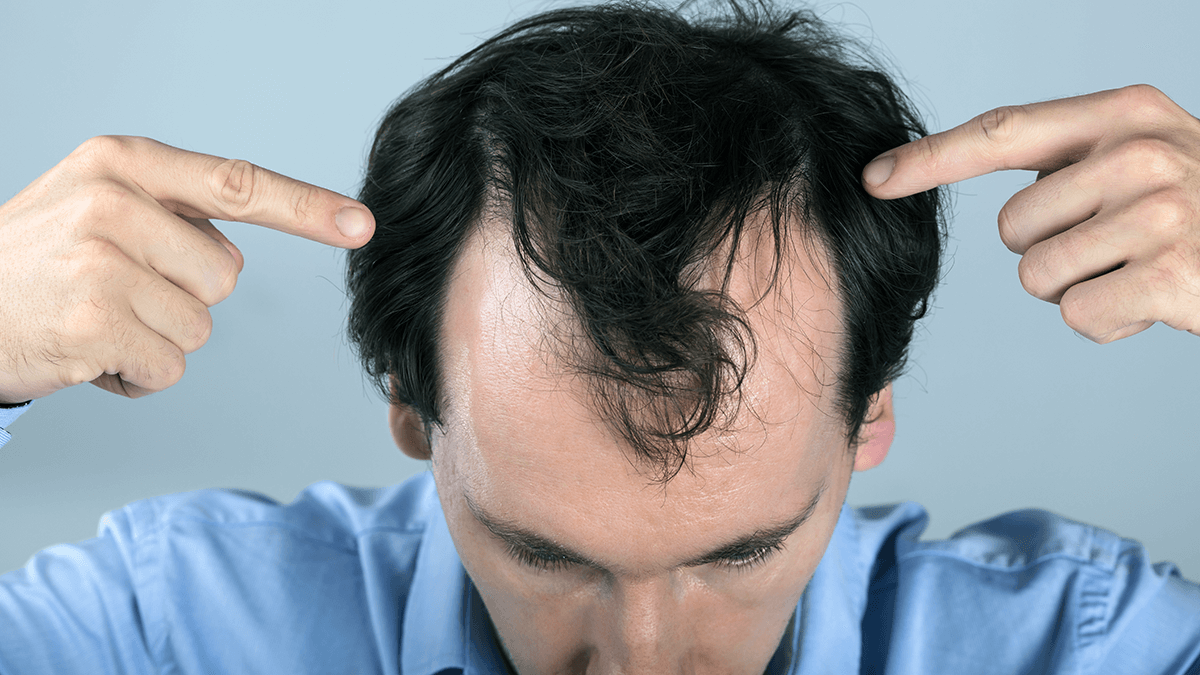 Forehead Hair Transplant - All you need to know 2023