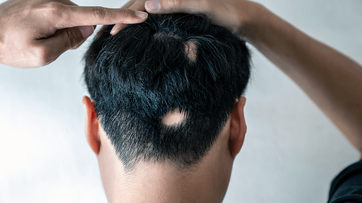 Hair Loss Symptoms - The various types and variants