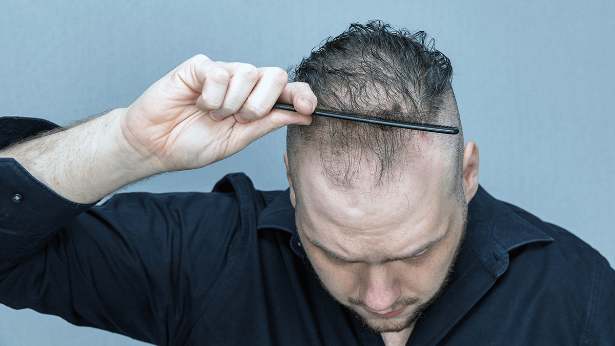 Thinning Hair - Causes, symptoms and treatments in 2023