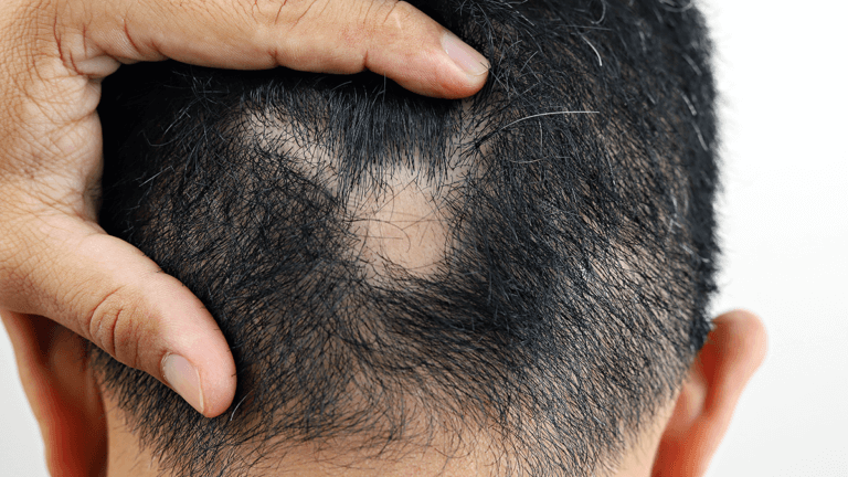 Bald Spots Hair Transplant - All you need to know 2024