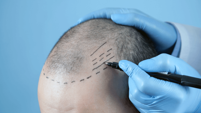 Hair Transplant Areas in 2025 - Donor & Recipient areas